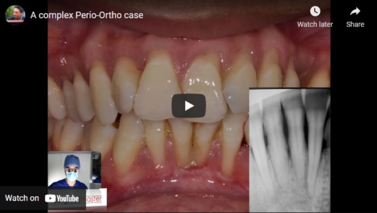 Complex Perio-Ortho Case | Surgical Master