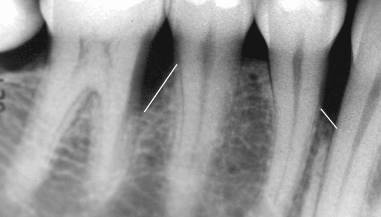 Perio Surgery Formula | Surgical Master