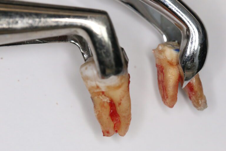 The Zone Extraction Method | Surgical Master