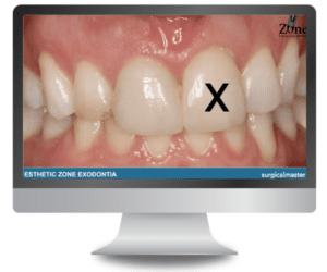 Zone Extraction Method | Surgical Master
