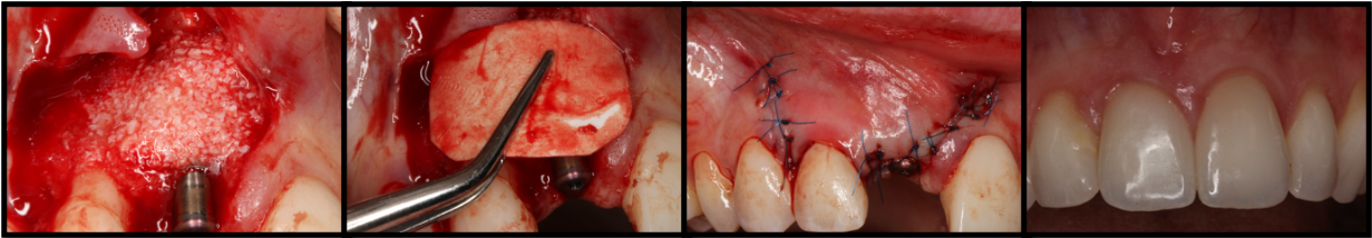 Bone Grafting Live Course | Surgical Master
